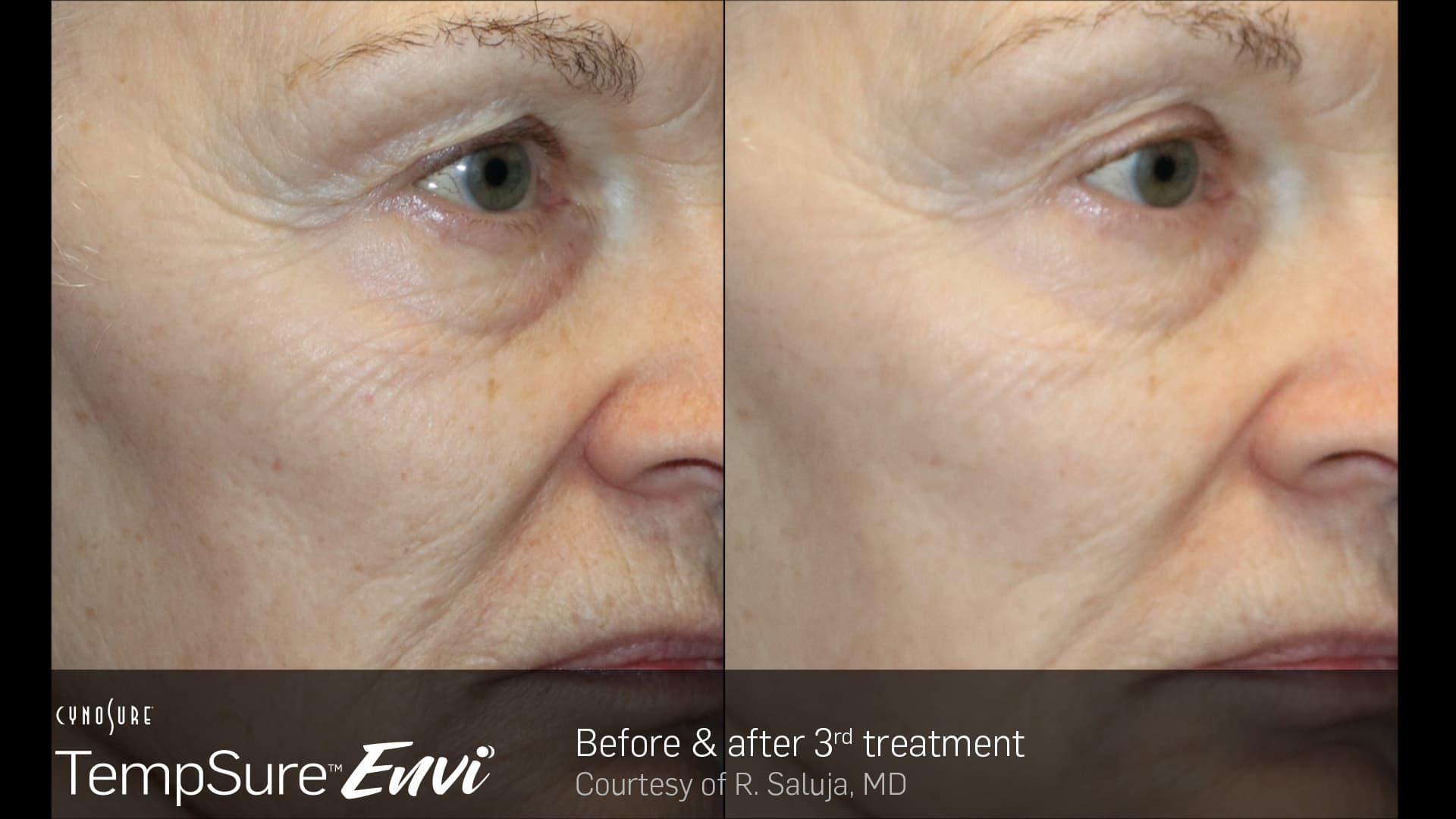 Tempsure Envi Before And After Image 8 Thin Md Med Spa